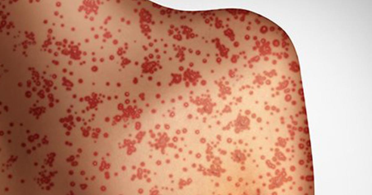 Bolile Copilariei explicate pas cu pas. Poze, tratament